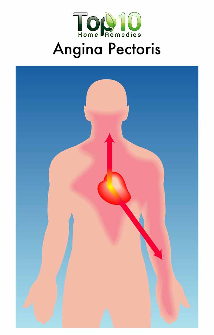 Home Remedies For Chest Pain Angina Top 10 Home Remedies