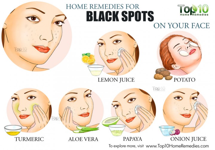 10 Home Remedies to Get Rid of Dark Spots on Face | Top 10 Home Remedies