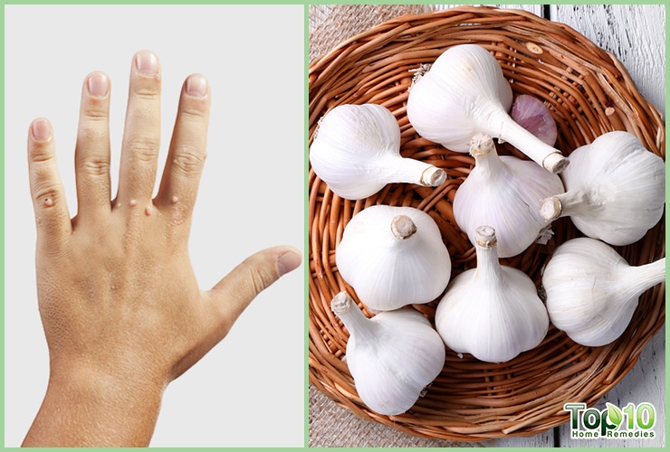 Home Remedies for Warts | Top 10 Home Remedies