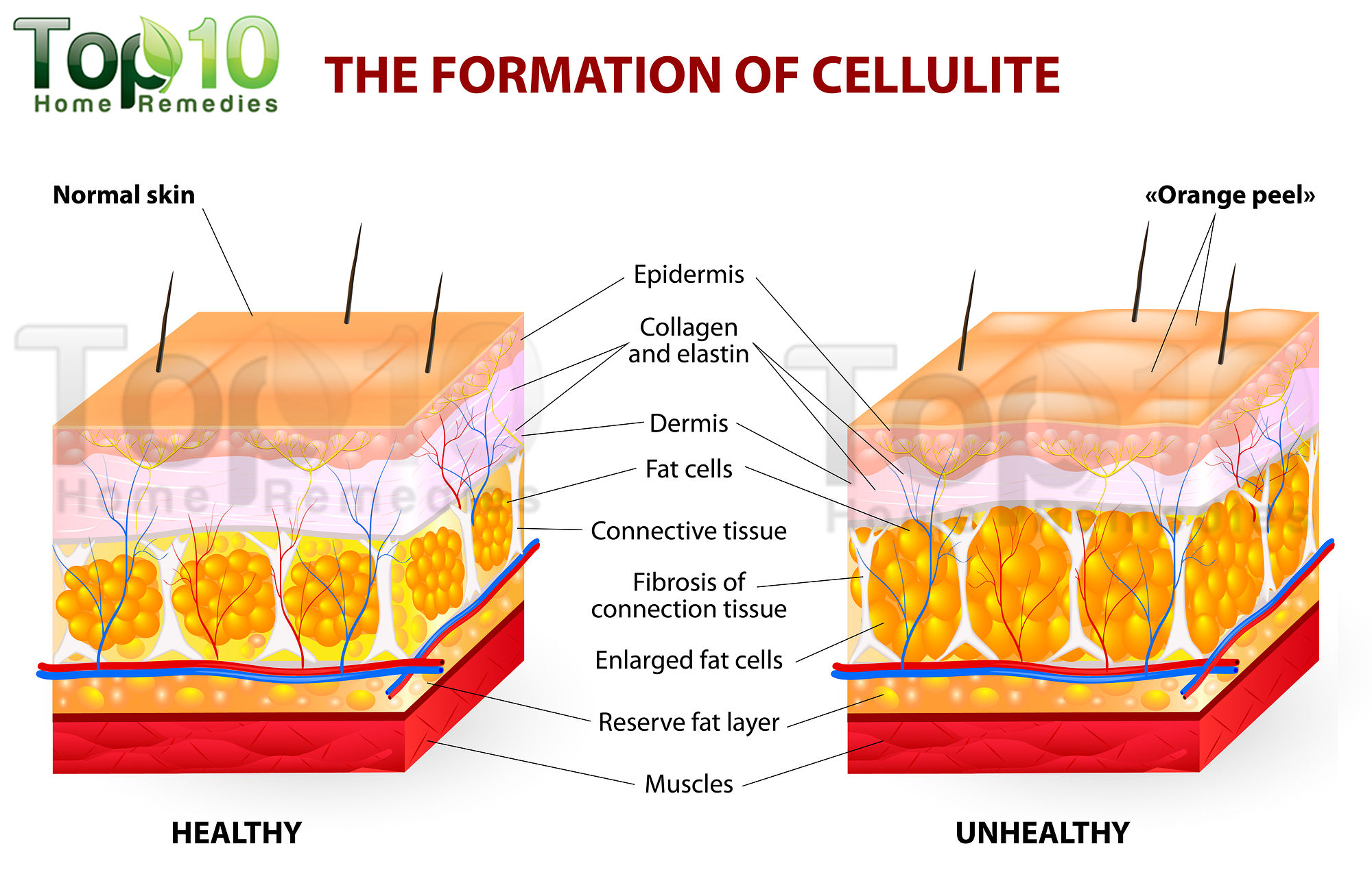 How To Get Rid Of Cellulite In Thighs Top 10 Home Remedies