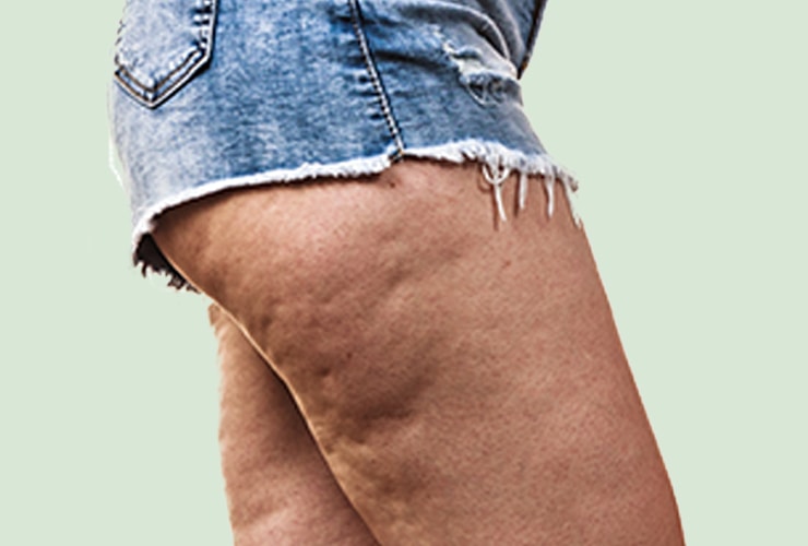 How To Get Rid Of Cellulite In Thighs Top 10 Home Remedies How To Get Rid Of Cellulite In Thighs Top 10 Home Remedies