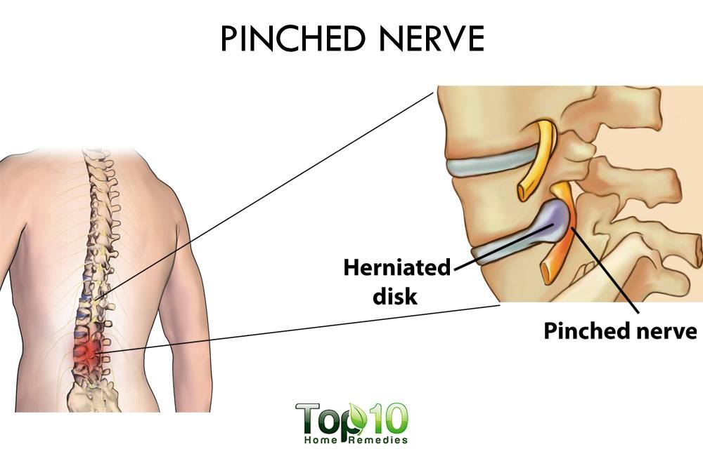 Home Remedies For A Pinched Nerve Top 10 Home Remedies Home Remedies For A Pinched Nerve Top 10 Home Remedies