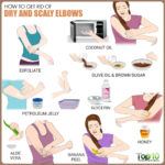 How to Treat Dry and Scaly Elbows with Home Remedies | Top 10 Home Remedies
